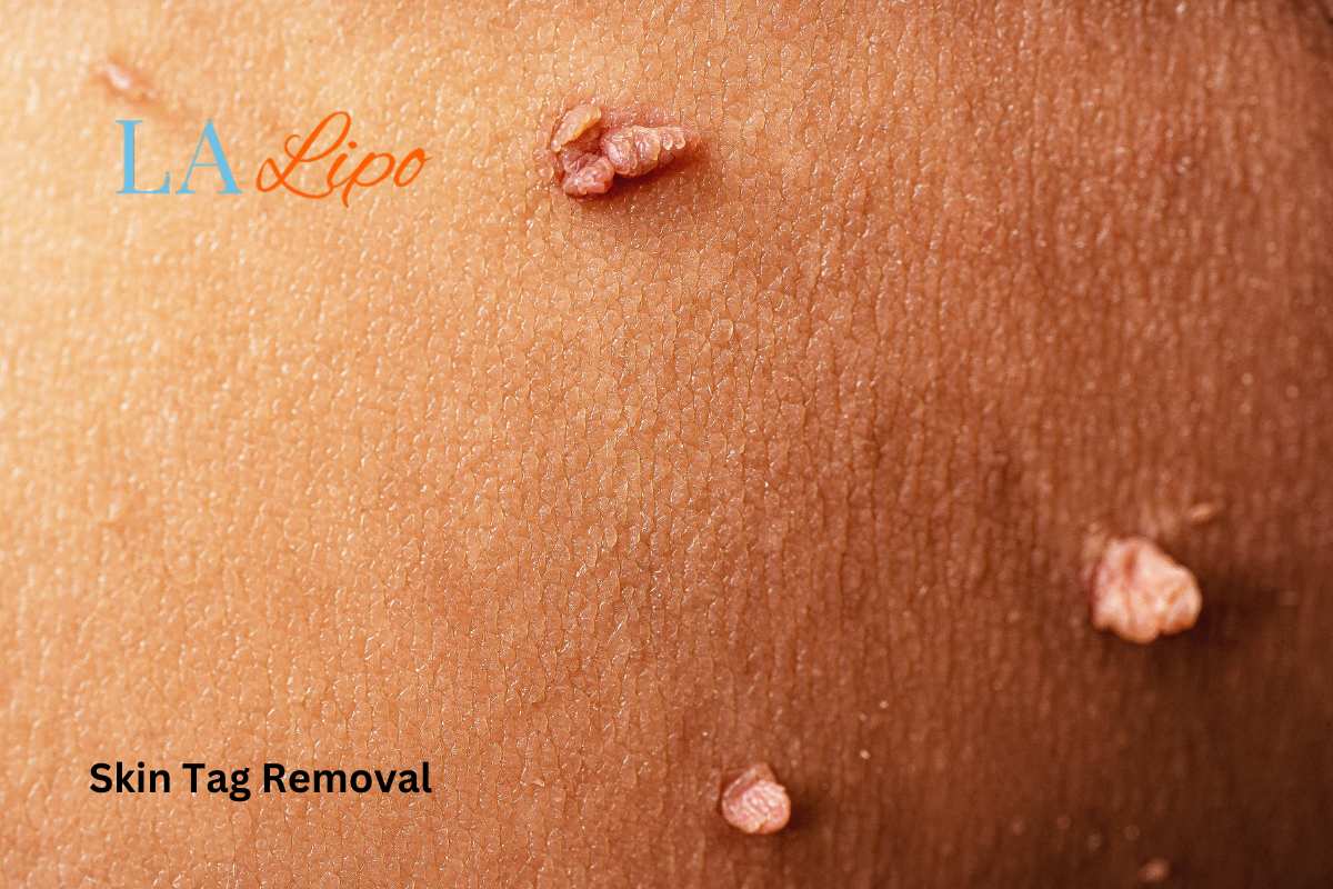 What Does Skin Look After Skin Tag Removal Nottingham